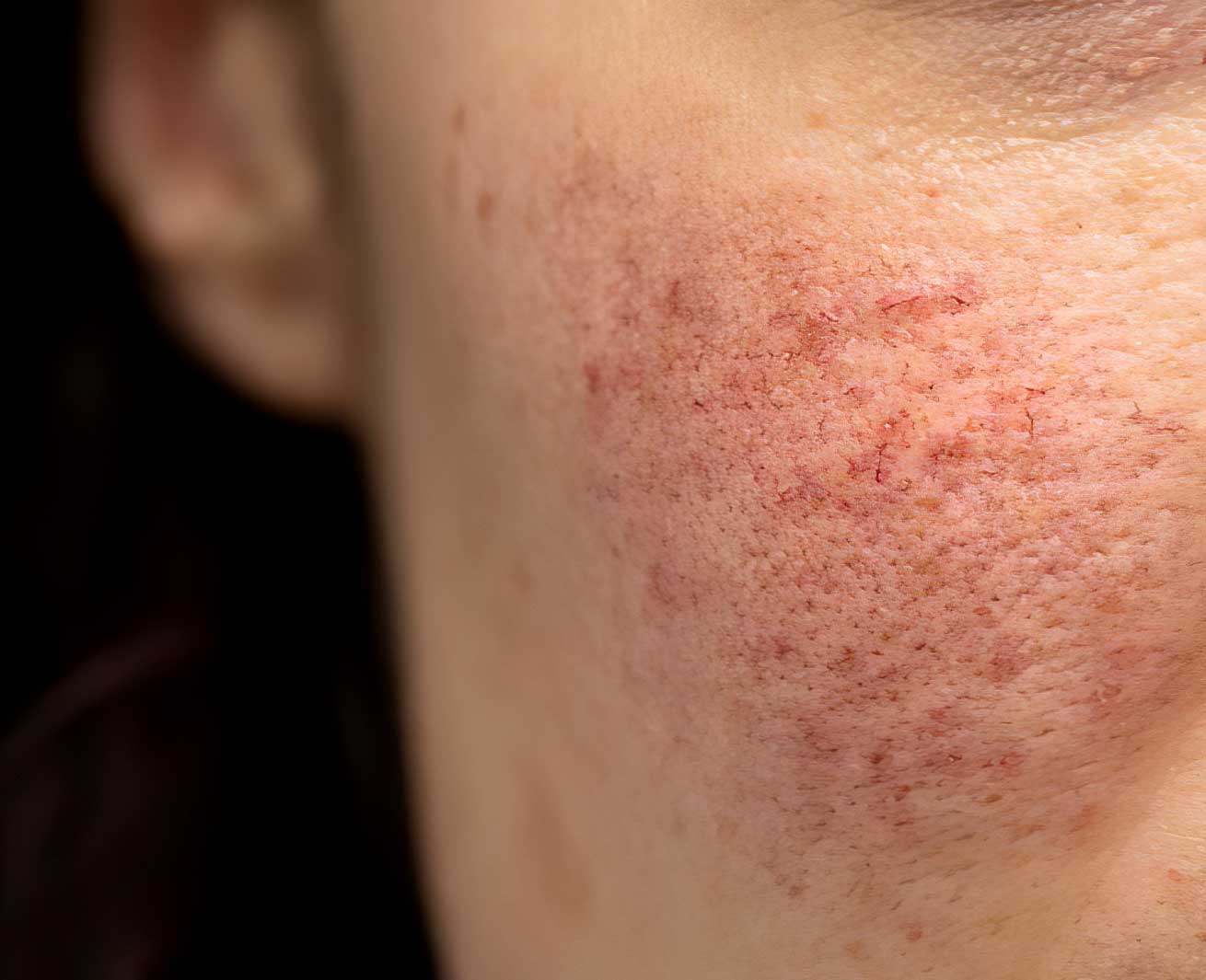 Αγγειακές βλάβες - Improve Your Skin - Ιατρείο Δερματολόγου Π. Ρήγα